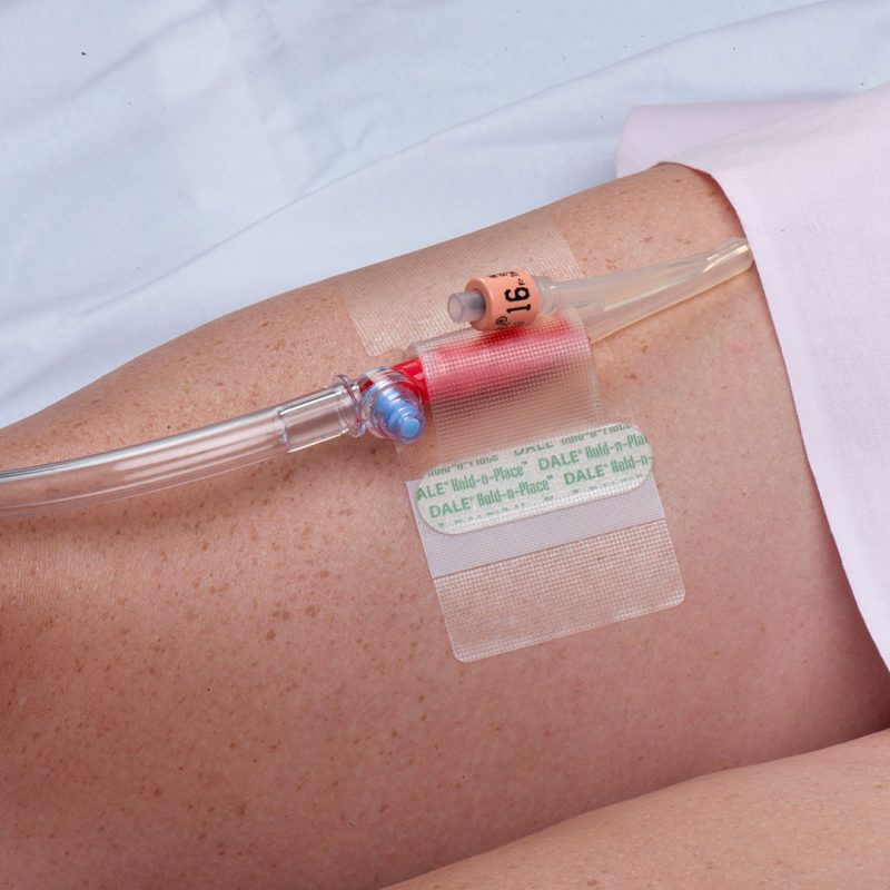 Hold-N-Place Adhesive Patch Foley Catheter Holder » GHC USA Global ...